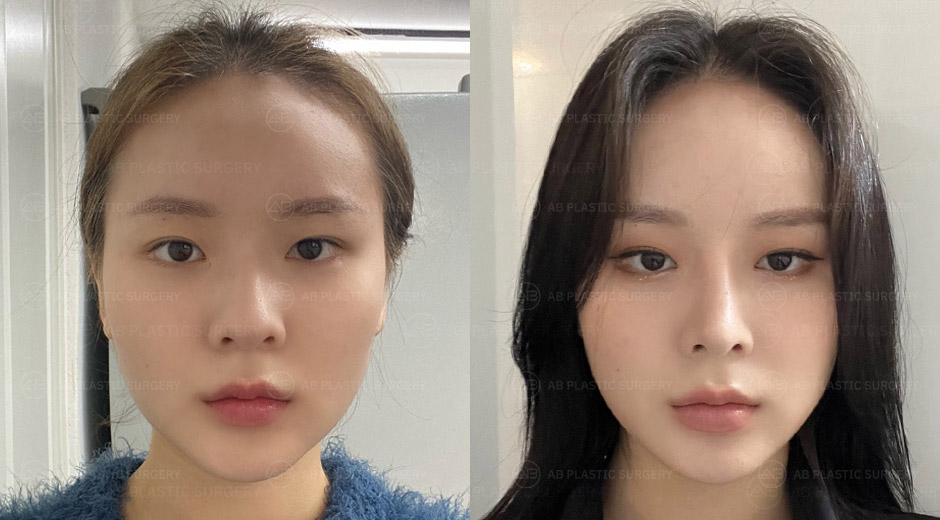 I am so happy with the beautiful cosmetic surgery that fits well with my facial proportions.